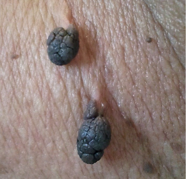 What Is A Skin Tag And Should You Remove It Beauty Bloggers